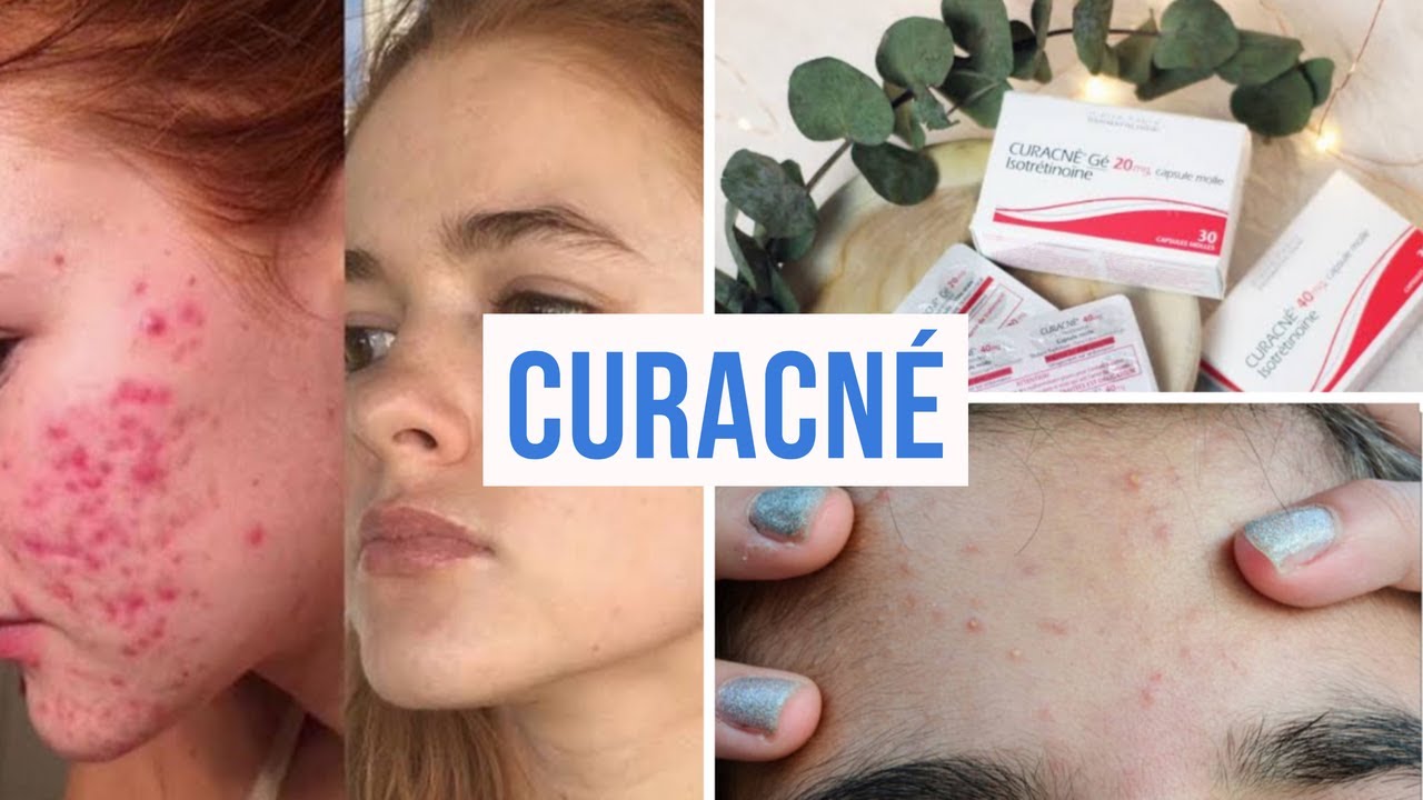 Prix pour isotretinoin — expédition sur Internet