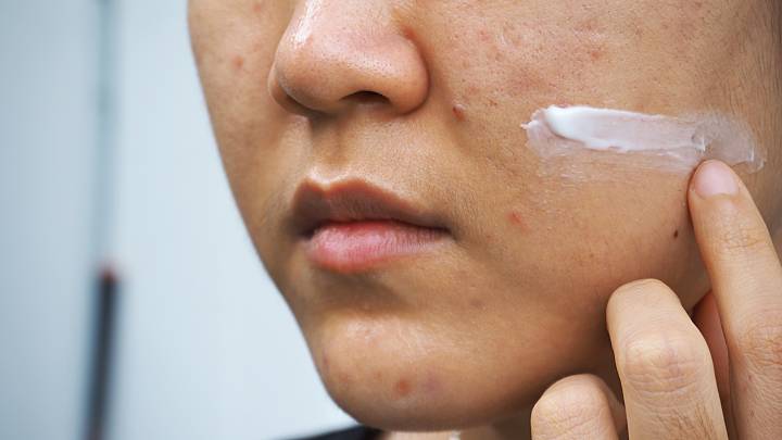 Isotrex gel online — sur Internet sans ordonnance