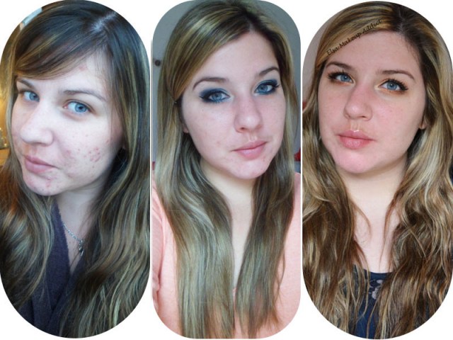 Roaccutane cachet prix — sur Internet sans ordonnance